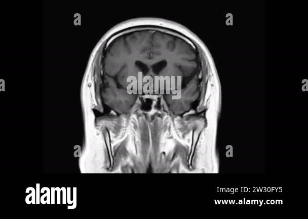 MRI Brain coronal t2 gradiente view for detect stroke disease and covid ...