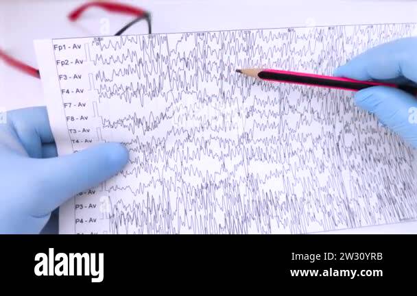 A neurologist examines an encephalogram of a patients brain. Schedule ...