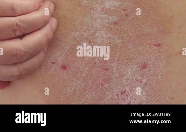 Psoriatic rashes Stock Videos & Footage - HD and 4K Video Clips - Alamy