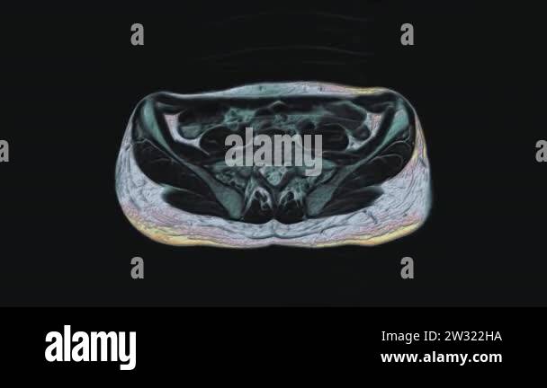 Bulk multicolored MRI of the female pelvic organs, abdominal cavity ...