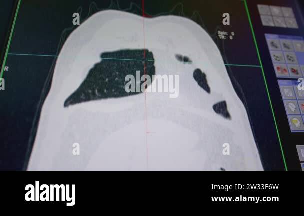 The result of a scan of the lungs on a computed tomograph. Lung model ...