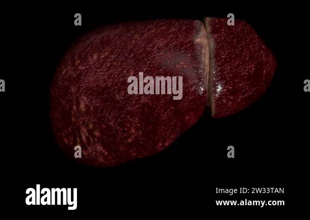 Liver pathology Stock Videos & Footage - HD and 4K Video Clips - Alamy