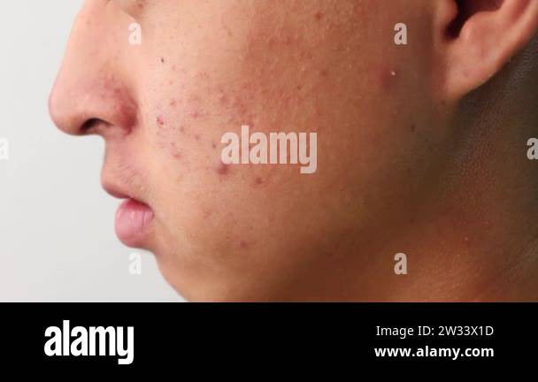Close-up the side face of Asian teenage guy with acne and skin problems ...