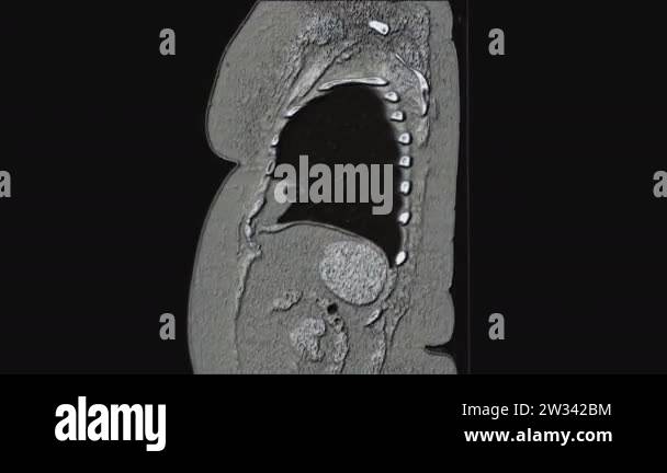 Voluminous color MRI of the lungs and bronchi, diagnosis of viral or ...
