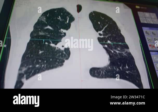 The result of a scan of the lungs on a computed tomograph. Lung model on a computer screen. CT ...