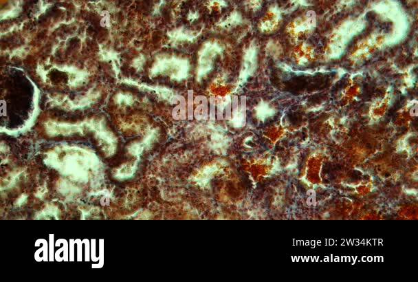 Kidney diseased tissue under the microscope 100x Stock Videos & Footage ...