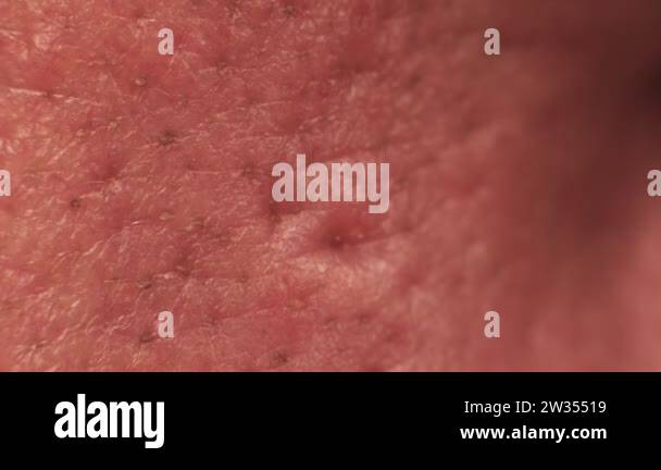 Macro of the nose with non groomed ditry skin and contaminated pores ...