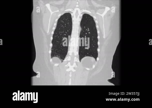 Purified MRI of the lungs and bronchi, diagnosis of viral respiratory ...