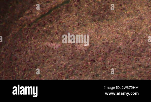 Heart scar Stock Videos & Footage - HD and 4K Video Clips - Alamy