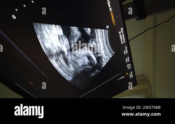 Medical ultrasound scanning, baby silhouette on the screen. Ultrasound ...