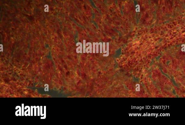 Carcinoma uterus in Darkfield tissue under the microscope 200x Stock ...