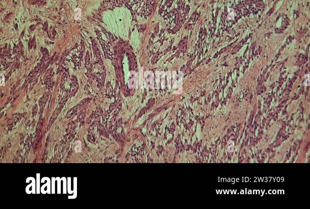benign tumor of the uterus under the microscope 100x Stock Video ...