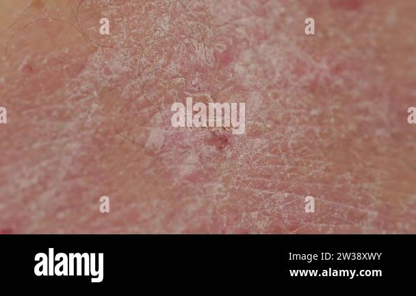 psoriasis: close up of the skin of the back of a person affected by ...