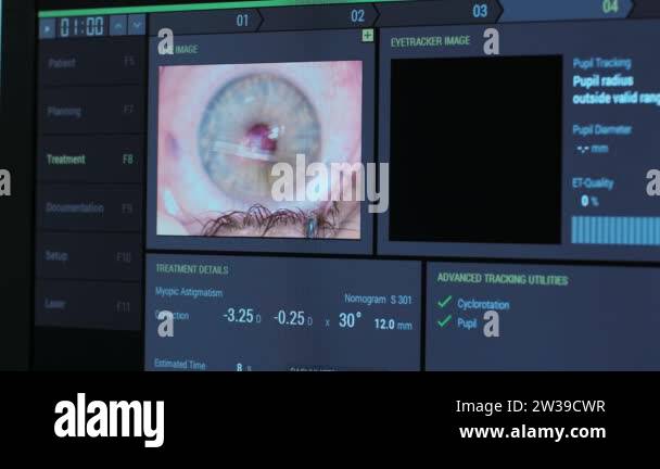 Ophthalmic surgery. View on the screen of medical monitor in operating ...