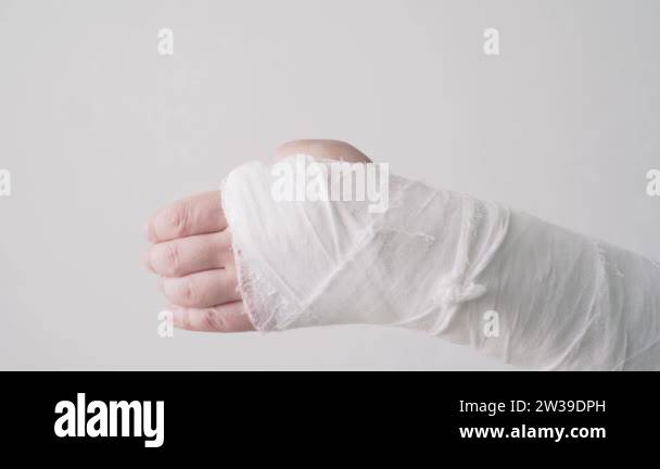 The broken arm of a man in gypsum shows the like with his thumb ...