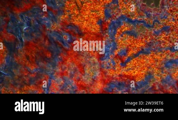 large intestine inflamation in Darkfield tissue under the microscope ...