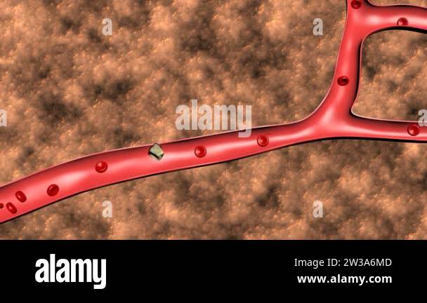 Arterial thrombosis Stock Videos & Footage - HD and 4K Video Clips - Alamy
