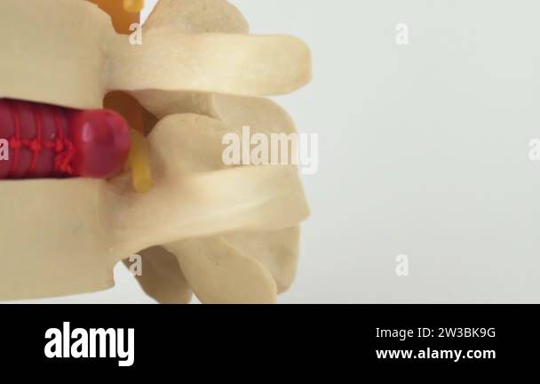 Lumbar spinal canal stenosis Stock Videos & Footage - HD and 4K Video ...