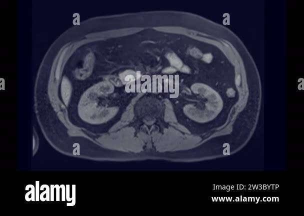 MRCP or Magnetic resonance cholangiopancreatography axial view showing ...