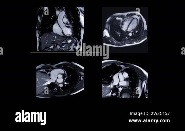 MRI heart or Cardiac MRI ( magnetic resonance imaging ) of heart in ...