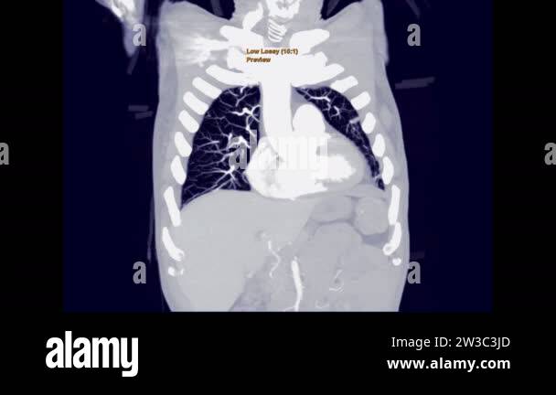 CTA for PE or pulmonary embolism , CT Chest with contrast media agent ...