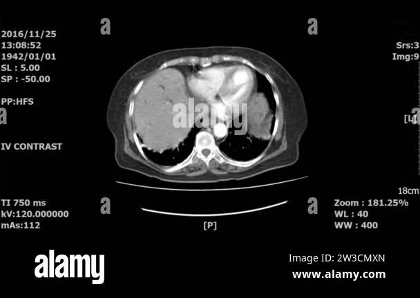 Abnormal ct of abdomen Stock Videos & Footage - HD and 4K Video Clips ...
