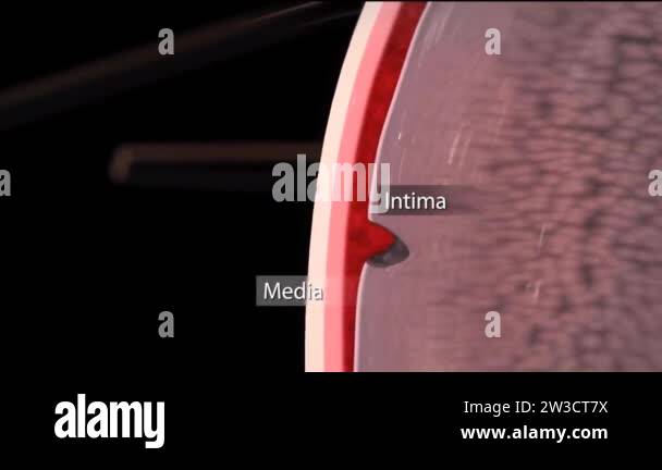 Angiogram of the abdominal aorta Stock Videos & Footage - HD and 4K ...