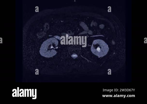 MRCP or Magnetic resonance cholangiopancreatography axial view showing ...