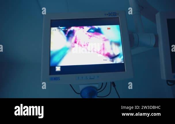 Modern equipment in the surgery room. Operation on the monitor. Process ...