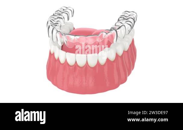 Invisalign removable and invisible retainer placement on lower jaw over ...