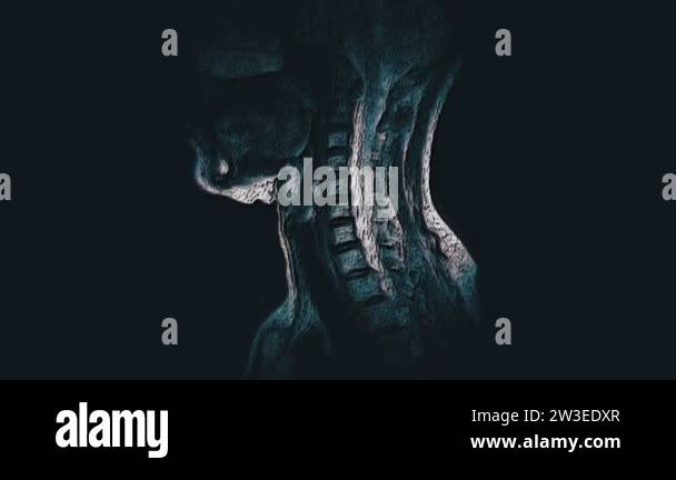 Voluminous color MRI of the cervical spine, detection of protrusions ...