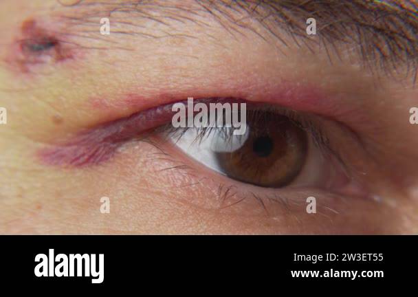 close view of a bruise near the eye, the face of a man with a hematoma ...