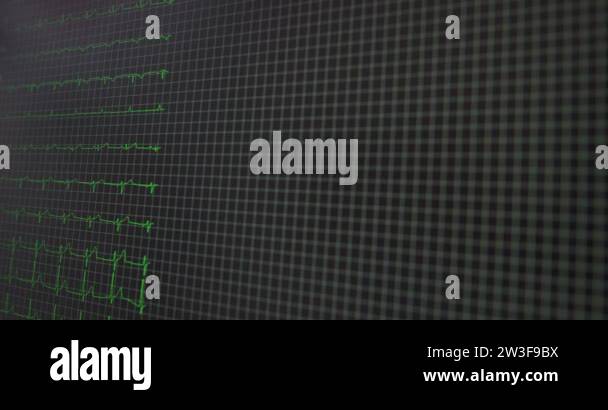 Patient Monitor Displays Vital Signs ECG Electrocardiogram EKG, Oxygen ...