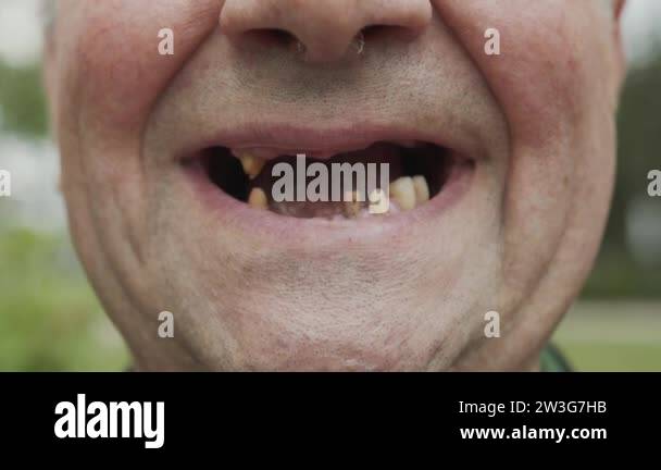 Poor teeth Stock Videos & Footage - HD and 4K Video Clips - Alamy