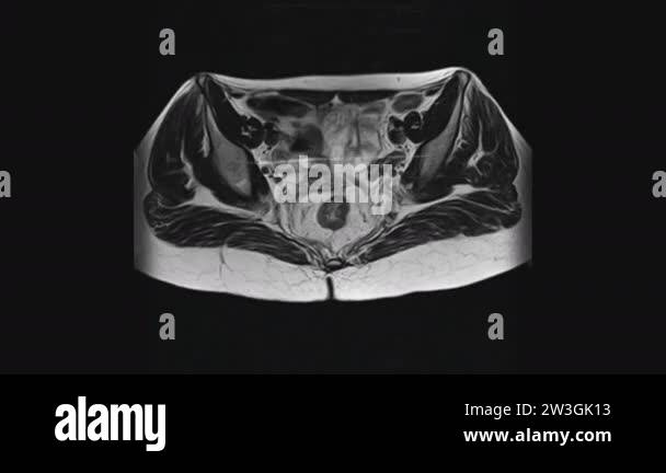 MRI of the female pelvic organs, abdominal cavity, gastrointestinal ...