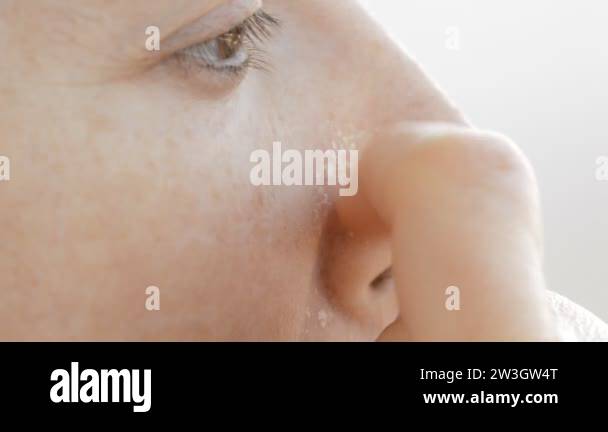 Young woman scratching his nose with finger with atopic dermatitis ...