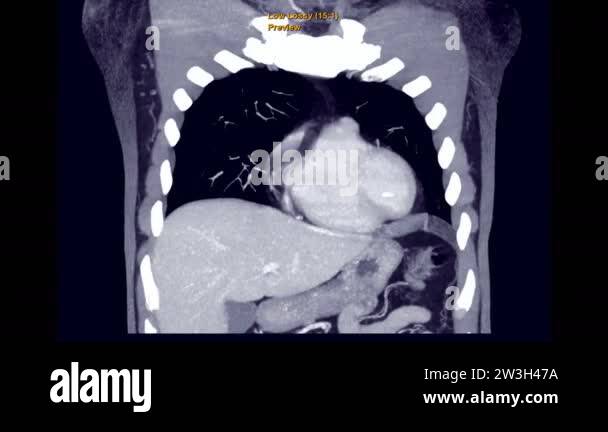 CTA for PE or pulmonary embolism , CT Chest with contrast media agent ...