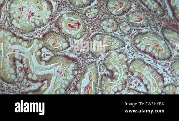 The growth of a Peutz-Jger polyp from the intestine rotates under the ...