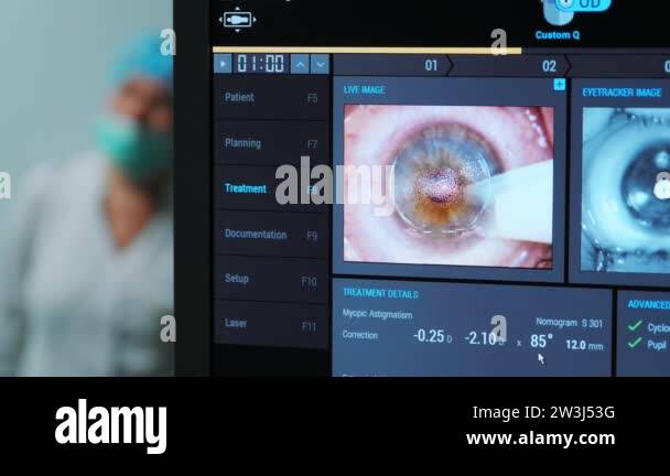 Ophthalmic surgery. View on the screen of medical monitor in operating ...