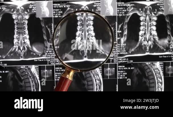 MRI lumbar spine background, magnetic resonance tomography. Doctor ...