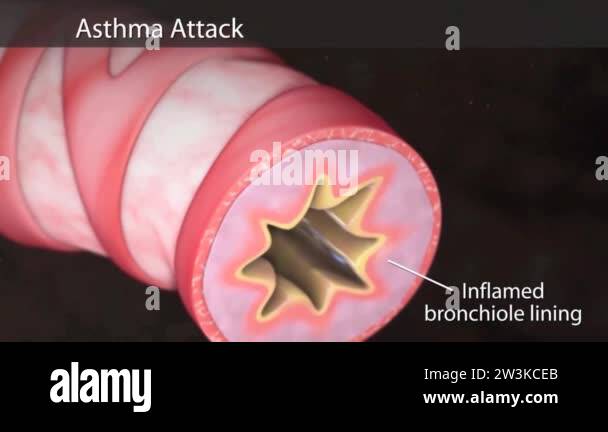 Human lungs with bronchi of mesh of model. Looping motion animated 3d ...