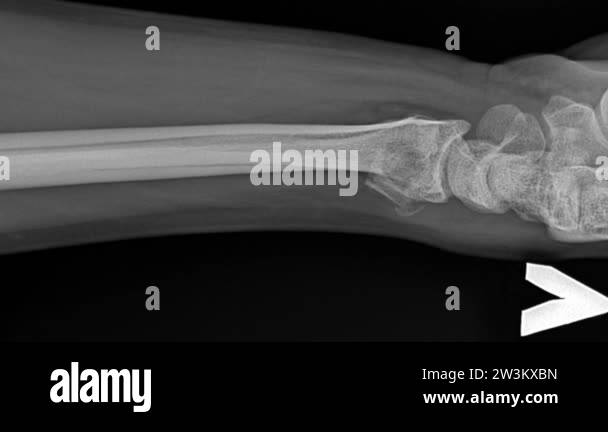 Bone trauma skeleton Stock Videos & Footage - HD and 4K Video Clips - Alamy