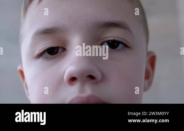 Boy Teen with Drooping Upper of Eyelid, Long Lashes. Myopia. Operated ...