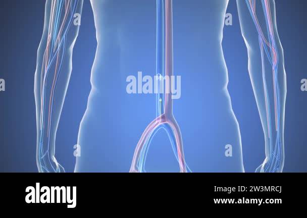 Hemoglobin Cells Flowing Through A Blocked Artery Causing Arteriosclerosis Disease Opening The