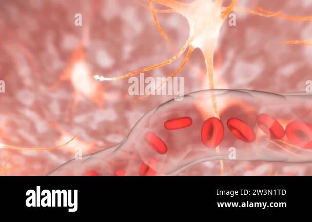 An animated simulation of a blood clot occurring in the brain, causing ...