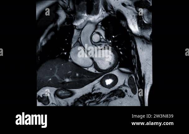 MRI heart or Cardiac MRI ( magnetic resonance imaging ) of heart in ...