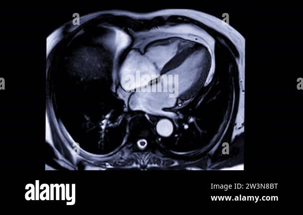MRI heart or Cardiac MRI ( magnetic resonance imaging ) of heart in ...