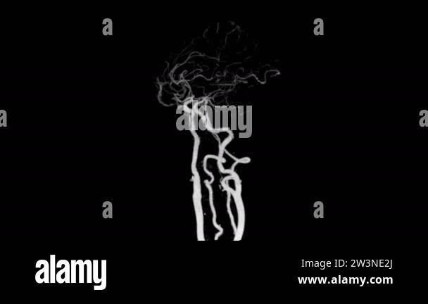 CTA Brain or computed tomography angiography of the brain 3D MIP image ...