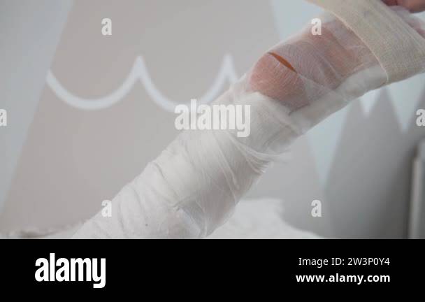 Close-up of plaster langette dressing after surgery to stitch the ...