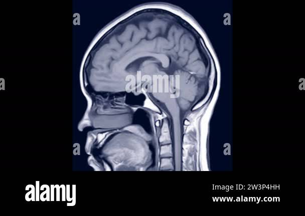 Mri brain scan sagittal view Stock Videos & Footage - HD and 4K Video ...